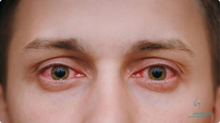 Causes of Red Eye and Its Treatment - Royal Spanish Center